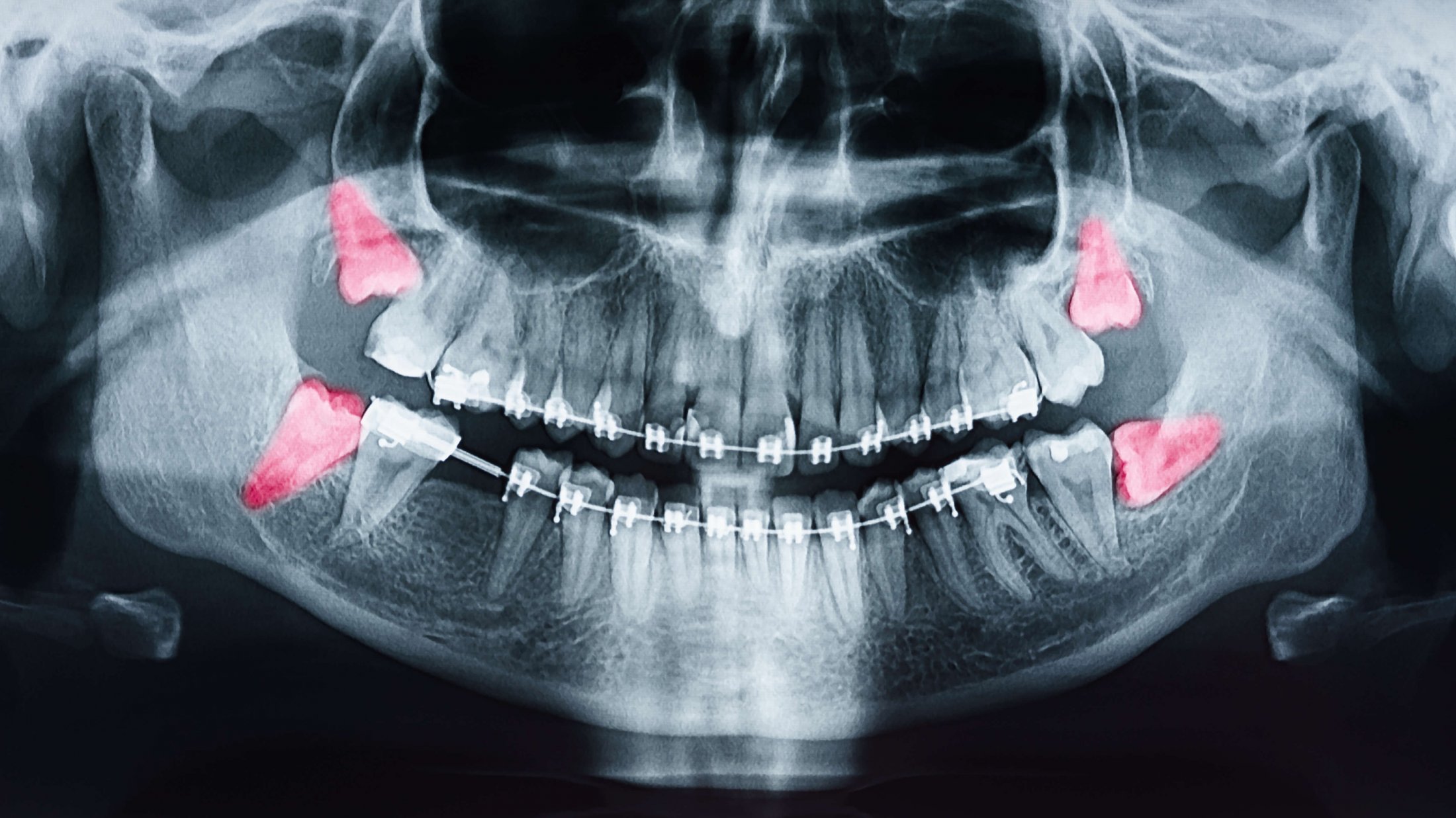Wisdom Teeth Removal in Birmingham | Buck and Phillips